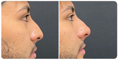 Rinomodelación: Corrige tu Nariz Sin Cirugía - Dorsia