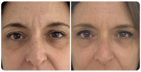 PhilArt: Bioestimulador con Polinucleótidos - Dorsia